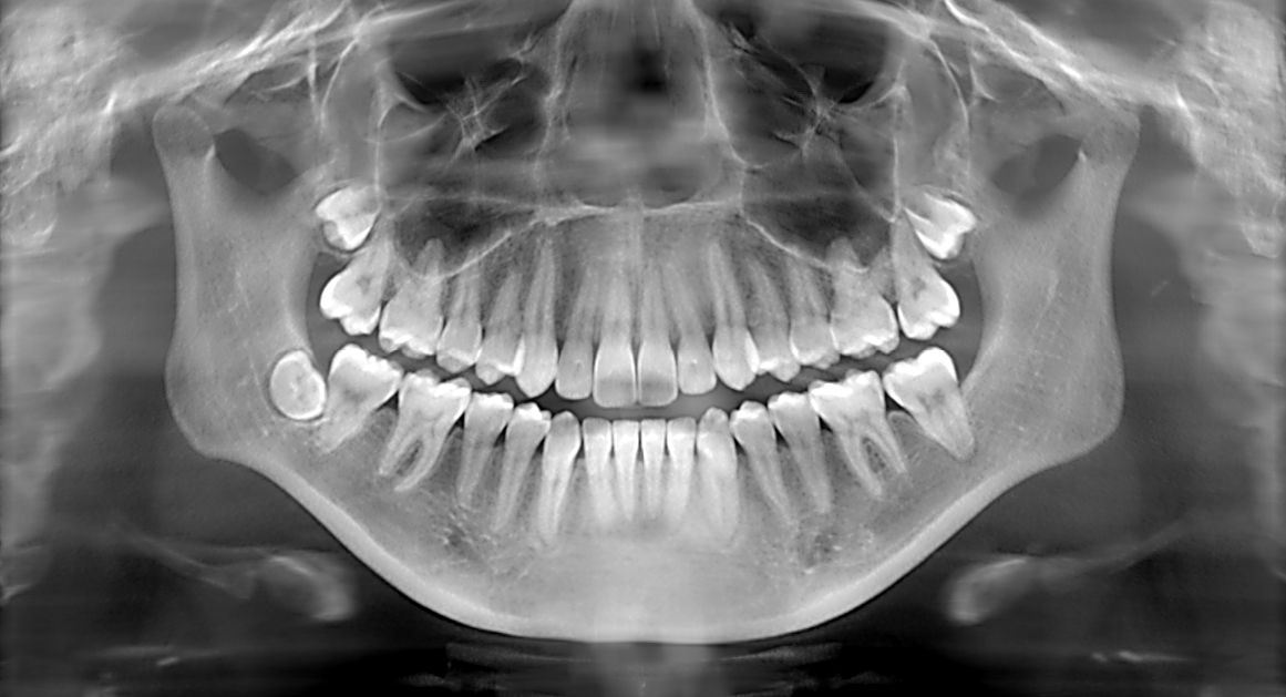 Digital Radiography - Miles City, MT - Hogan Family Dental