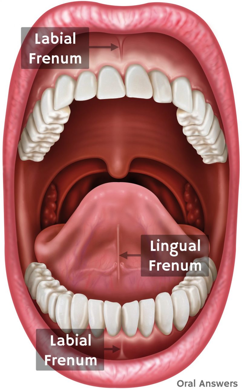 Scalpel-Free Frenectomy - Miles City, MT - Hogan Family Dental